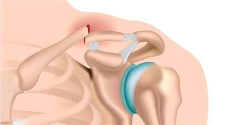 Broken Collar Bone Clavicle Fracture Symptoms Treatment And Rehab