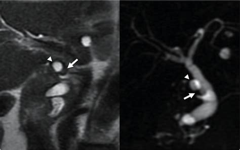 Magnetic Resonance Cholangiopancreatography Findings Magnetic