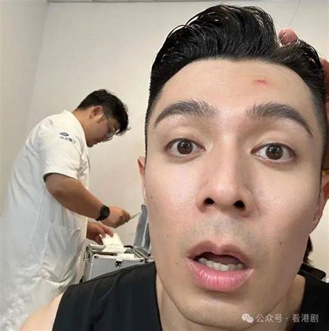 周柏豪爆额肿过鸡蛋 网民忧毁掉靓仔样伤口omg慰问