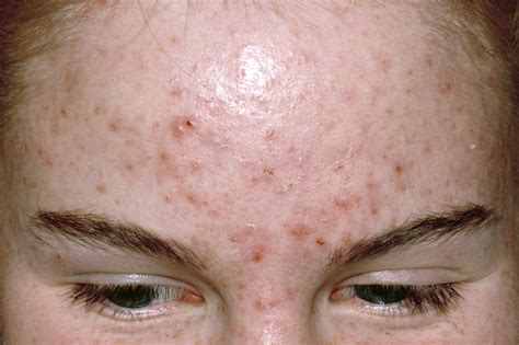Hormonal Anti Androgen Therapy Good Alternative To Systemic Antibiotics