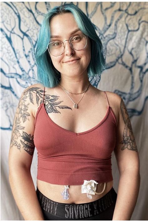 Gastrostomy Tube Tube Bra Enteral Feeding Tummy Issues Stoma