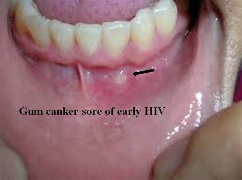 Early Or Acute” Hiv Mouth Sores Pictures