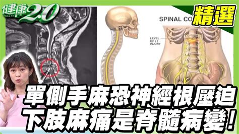 單側手麻恐神經根壓迫 下肢麻痛是脊髓病變！腰椎神經壓迫比例高 嚴重下半身麻痺【健康20精選】 Youtube