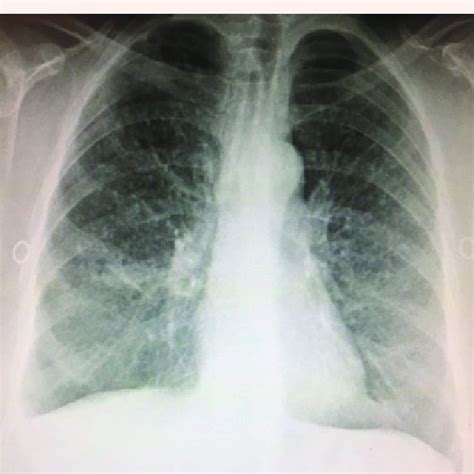 Axial Computed Tomography Showing Diffuse Miliary Nodules And Right Download Scientific Diagram