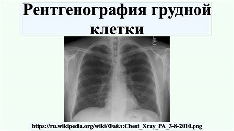 Рентгенография грудной клетки Youtube