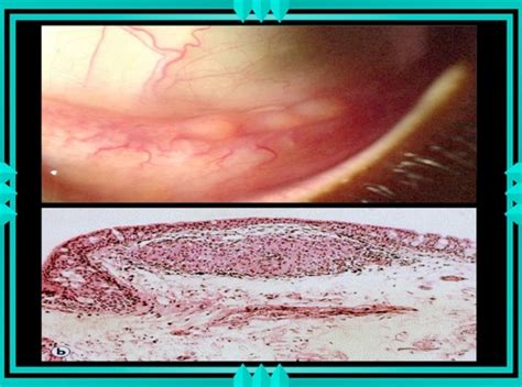 Opt 631 Ant Uveitis 4 Flashcards Quizlet