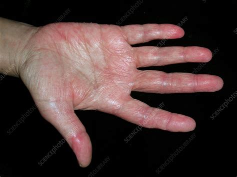 Dermatomyositis Stock Image C0560910 Science Photo Library