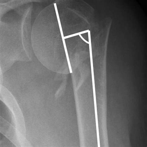 Pdf Outcomes Evaluation Of Locking Plate Osteosynthesis In Displaced Fractures Of The Proximal
