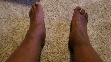 33 Weeks And 5 Days Pregnant Cankles Why Do My Legs Look Like Tree