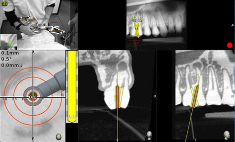 Dental News Dynamic Navigation—the Future Of Minimally Invasive