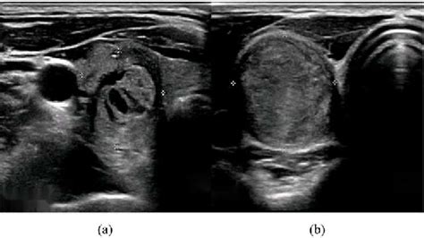 Figure 1 From Deep Learning Based Ultrasound Image Detection And