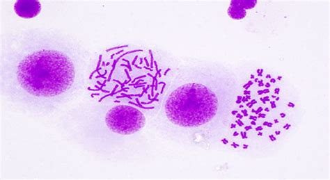 Thinking Outside The Chromosome How Ecdna Is Challenging Conventional