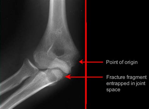 Distal Humerus Fractures Medial Epicondylar Fracture