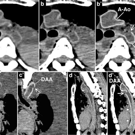 Traumatic Aortic Rupture As Cause Of Death On Postmortem Ct Although