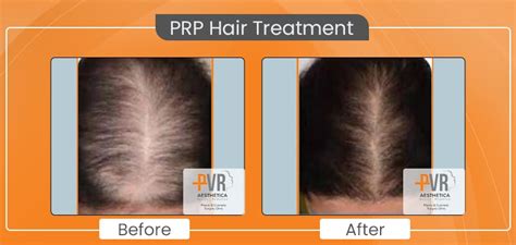 Best Prp Hair Treatment In Navi Mumbai Pvr Aesthetica