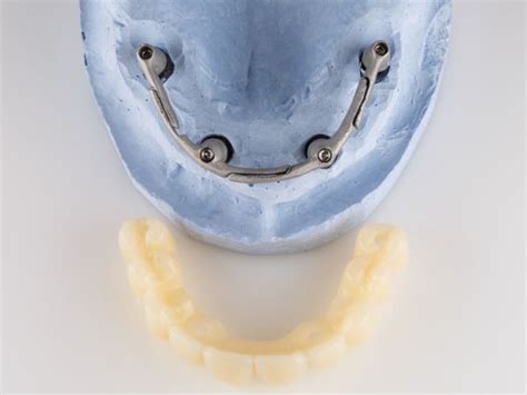 Implantes dentales de carga inmediata Clínica Dental Beladent