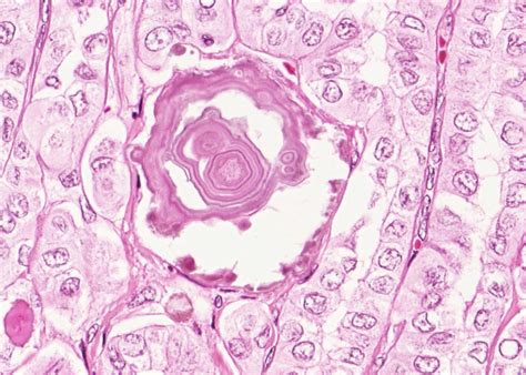 Thyroid Cancer 0515 Object Detection Dataset By Thyroid Cancer