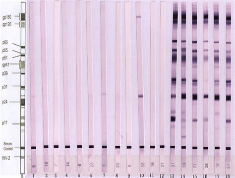 First Western Blot Analysis Of Human Sera For Urea Dissociation Tests
