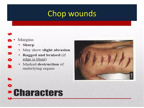 Stab And Chop Wounds Mb Singh 2020 Pptx