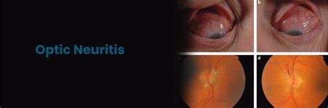 Understanding Optic Neuritis Causes Symptoms Risk Factors