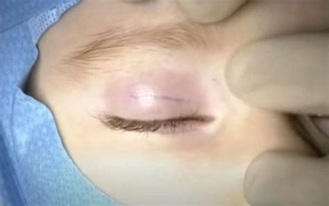 Excision Of Medial Dermoid Cyst On Eye Rpimplepopperdelight