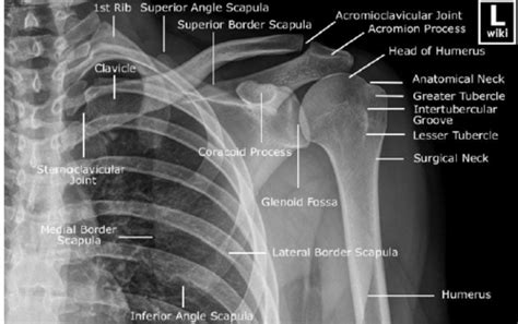 Upper Extremity Radiology Flashcards Quizlet