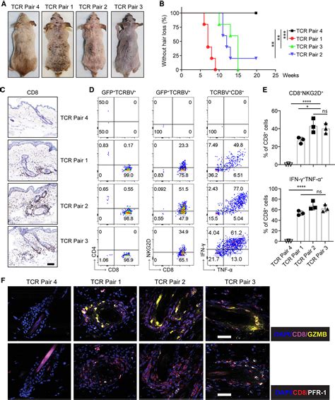 Single Cell Analysis Of Temporal Immune Cell Dynamics In Alopecia Areata Reveals A Causal Role