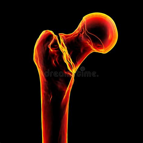 Basicervical Femur Fracture 3d Illustration Stock Illustration Illustration Of Diagram