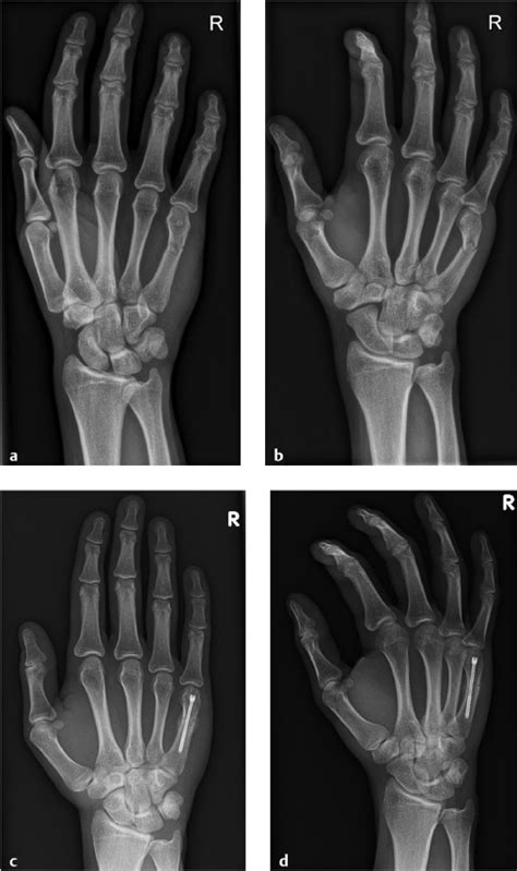 Intramedullary Screw Fixation Of The Metacarpals And Phalanges Of The Hand Musculoskeletal Key