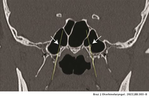 Anatomical Relationship Of Pterygoid Process Pneumatization And Vidian Canal Brazilian Journal