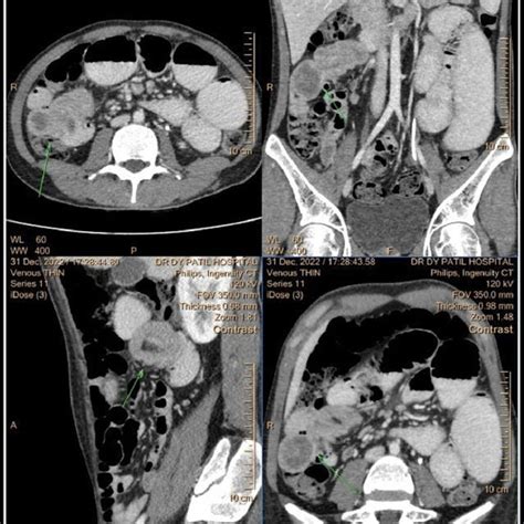 Cect Abdomen Showing Moderate To Severe Dilatation Of Jejunum Due To Download Scientific