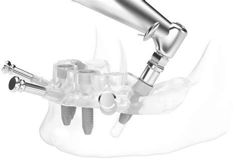 Surgical Implant Guides MediMatch Dental Laboratory