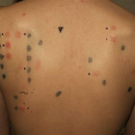 Positive Allergy Patch Test In Our Patient After 96 Hours Including A