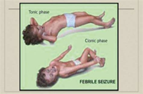 Simple Febrile Seizures