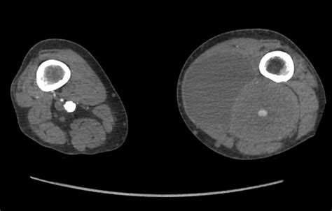 Preoperative Computed Tomography Scan Download Scientific Diagram