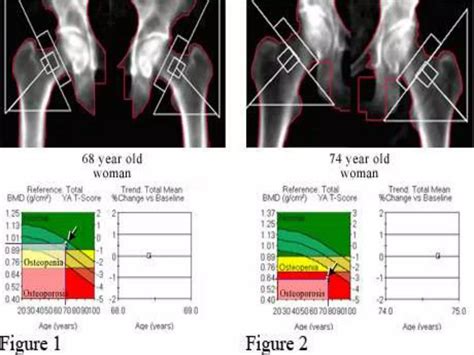 Bone Mineral Density Bmd Test Pptx
