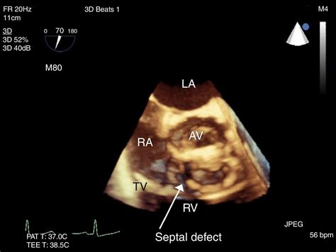 Intraoperative Transesophageal Echocardiography To Evaluate A Gerbode Defect Colombian Journal
