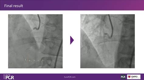 Robotic PCI Real Life Experience With A New Robotic Platform
