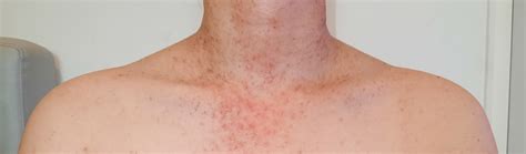 Acne Fúngica O Que é Causas Sintomas E Tratamentos