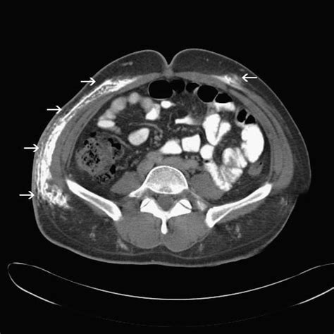 Dermatomyositis With Extensive Calcification In An Adult The Western