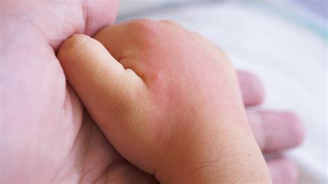 Casa Segura Kids Queimaduras em CrianÃas O Que Fazer Quando Acontece