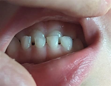 Under Bite 65yr Old Raskdentists