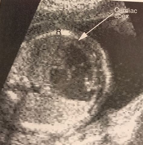 Ch Fetal Echo Flashcards Quizlet