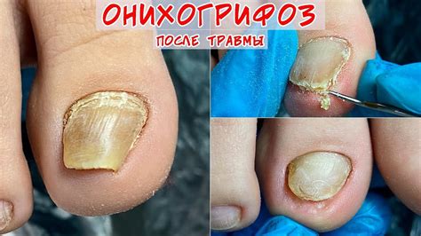 Онихогрифоз Толстый ноготь на ноге Youtube Nails Youtube Beauty