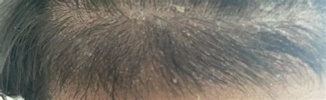 Help Rdandruff