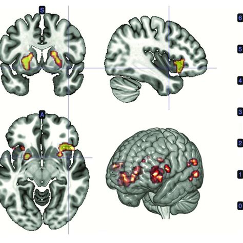 Statistical Non Parametric Map Of Significant Clusters Correlating To