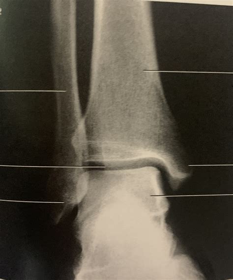 Ap Ankle Diagram Quizlet