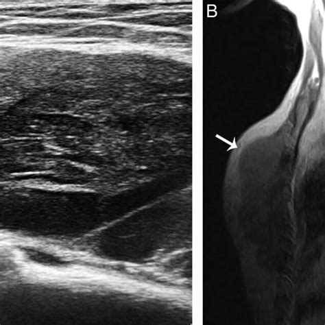 A Ultrasound With A Linear Probe Shows A Well Defined Hypoechoic Mass Download Scientific