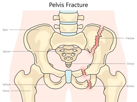 Pelvic Fractures Causes Symptoms And Best Treatment Options