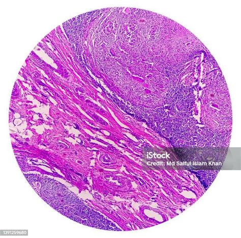 상피 조직세포는 결핵의 현미경 검사 기준에서 본다 만성 육아 종성 염증 Cgitb 세포에 대한 스톡 사진 및 기타 이미지 세포 0명 거대세포 인간의 세포 Istock